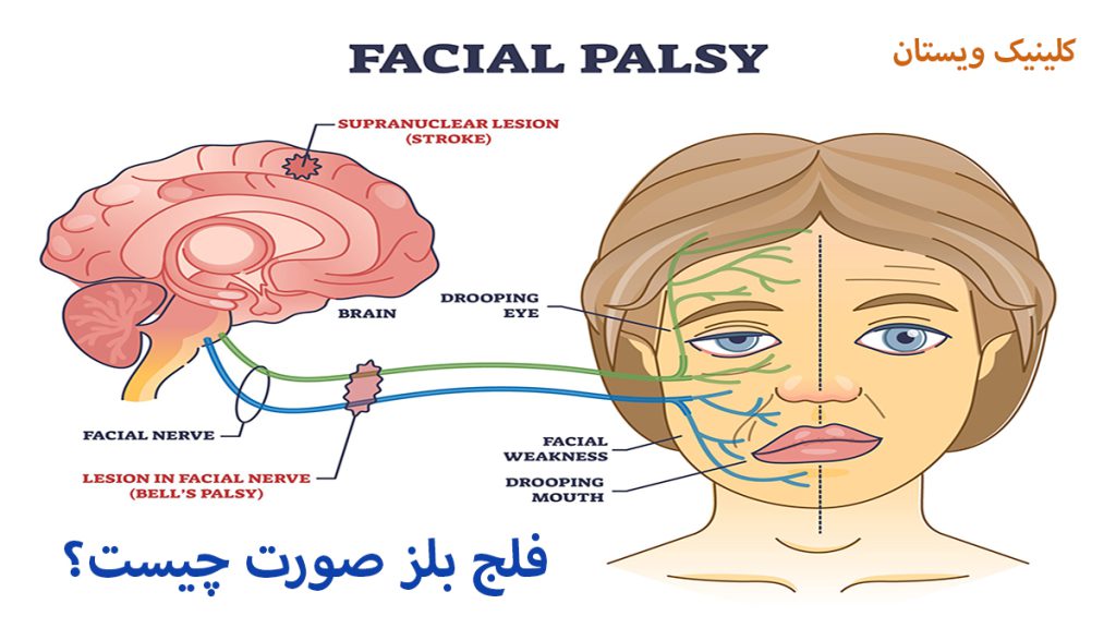 علت بیماری فلج بلزچیست؟علائم و درمان قطعی بیمای فلج بلز خفیف