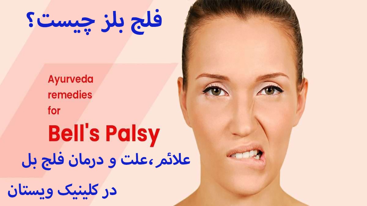 علت بیماری فلج بلزچیست؟علائم و درمان قطعی بیمای فلج بلز خفیف